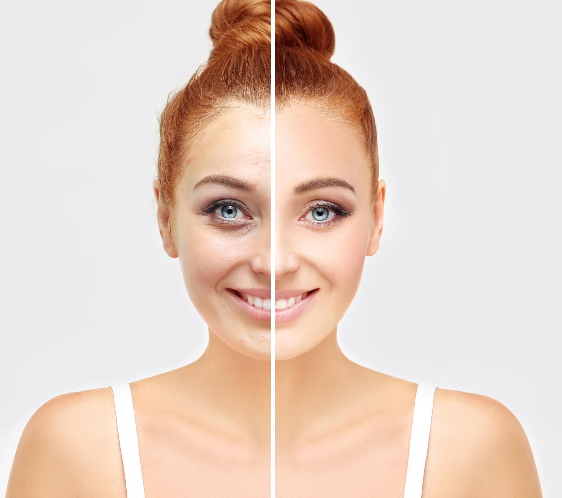 Couperosis, dilated vessels, angiomas - CMEA